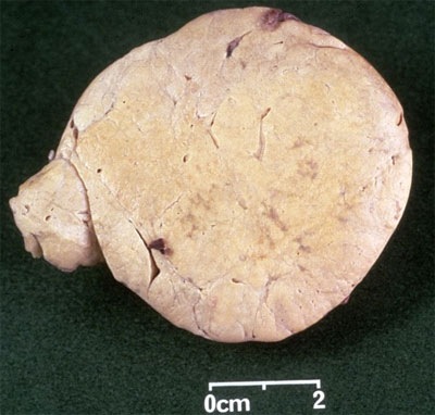 Cushing's & Cancer: Diagnosing Cushing’s syndrome